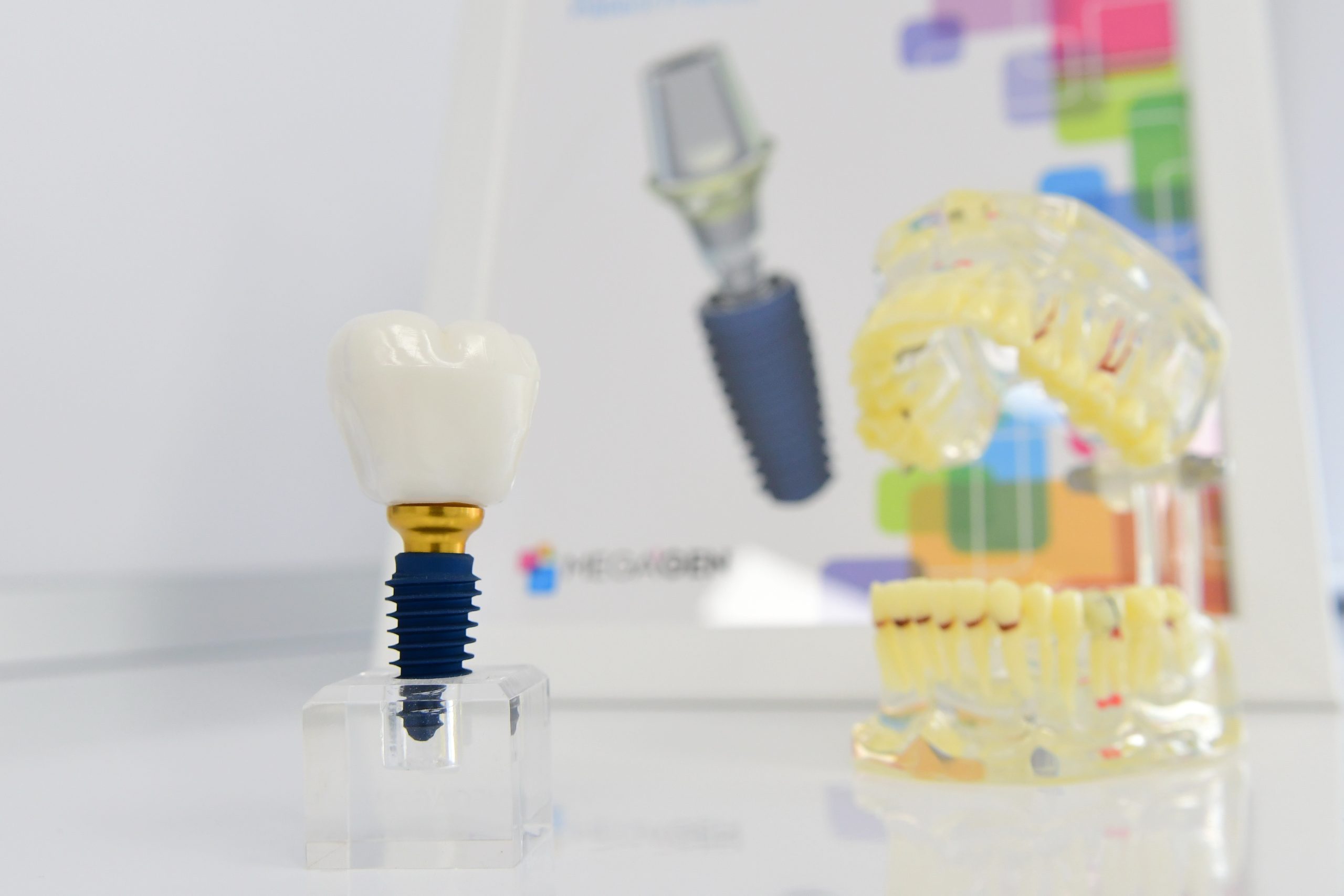 Implant dentar - Edent Clinic